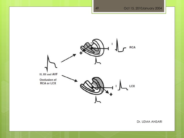 Localization of MI on ECG | PPT | Heart and Cardiovascular Diseases ...