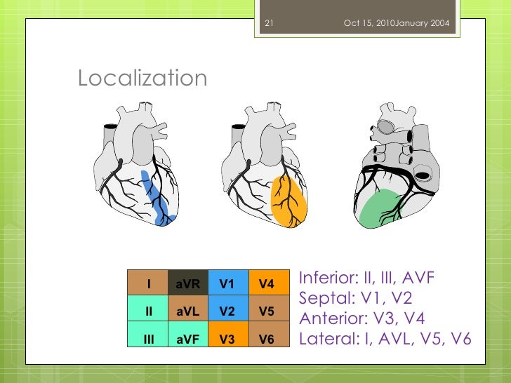 Localization of MI on ECG