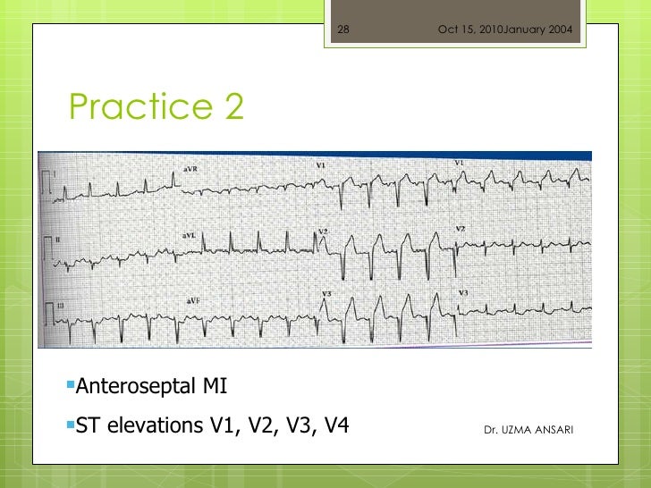 Localization of MI on ECG