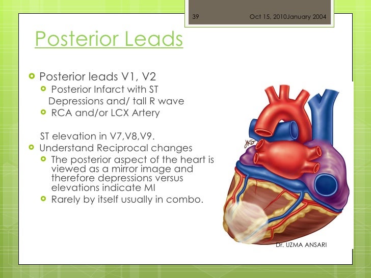Localization of MI on ECG