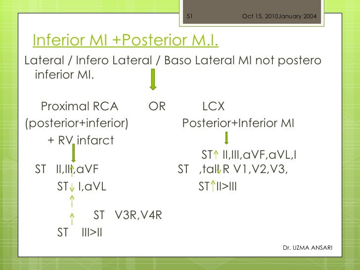 Localization of MI on ECG