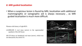 Localization of non palpable breast tumor for surgery | PPTX