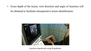 Localization of non palpable breast tumor for surgery | PPTX
