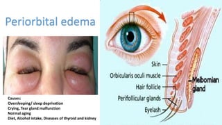 Localized edema by khadija brohi | PPT