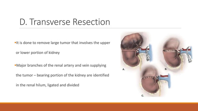 LOCALIZED RCC.pptx | Surgery | Medical Health