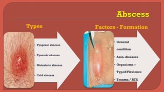 Localized Surgical Infections.pdf