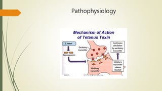 Localized Tetanus | PPT