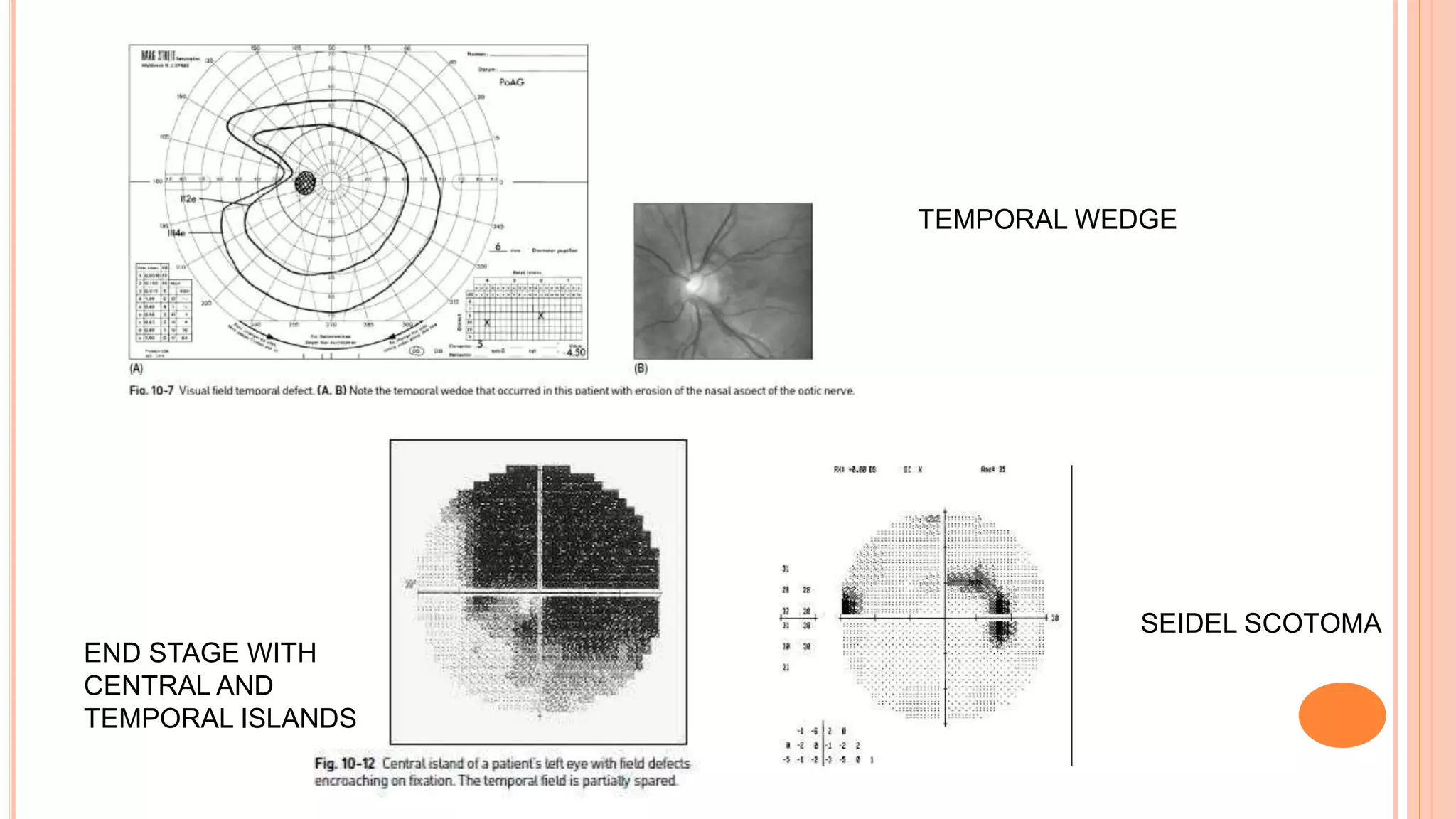 Localizing signs for lesion of visual pathway | PPTX