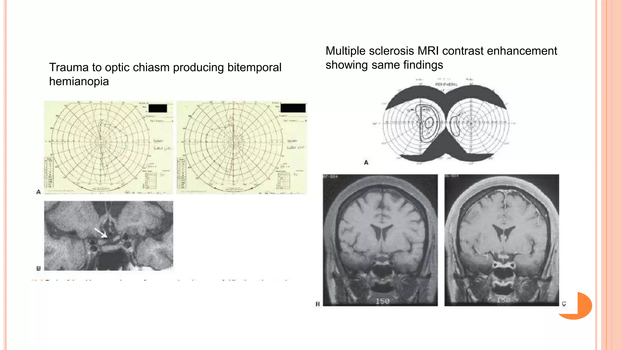 Localizing signs for lesion of visual pathway | PPTX
