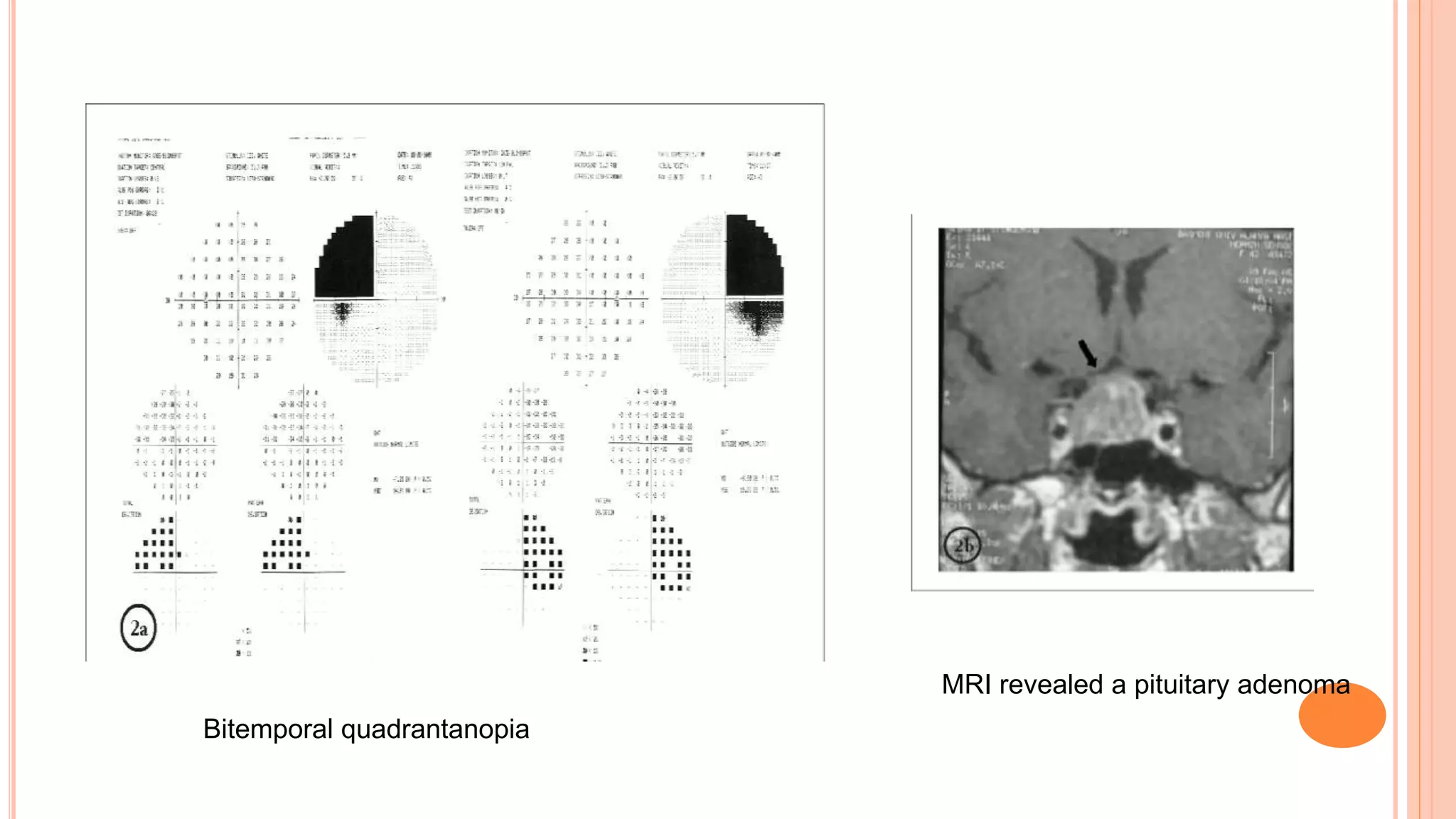 Localizing signs for lesion of visual pathway | PPTX