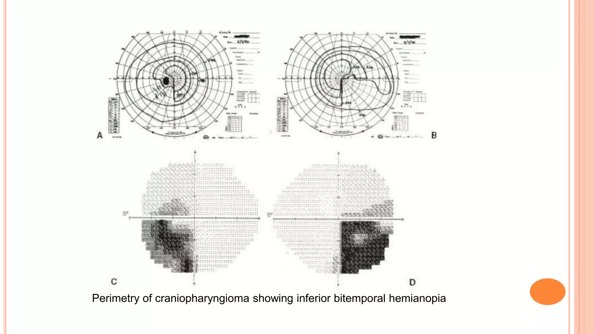 Localizing signs for lesion of visual pathway | PPTX