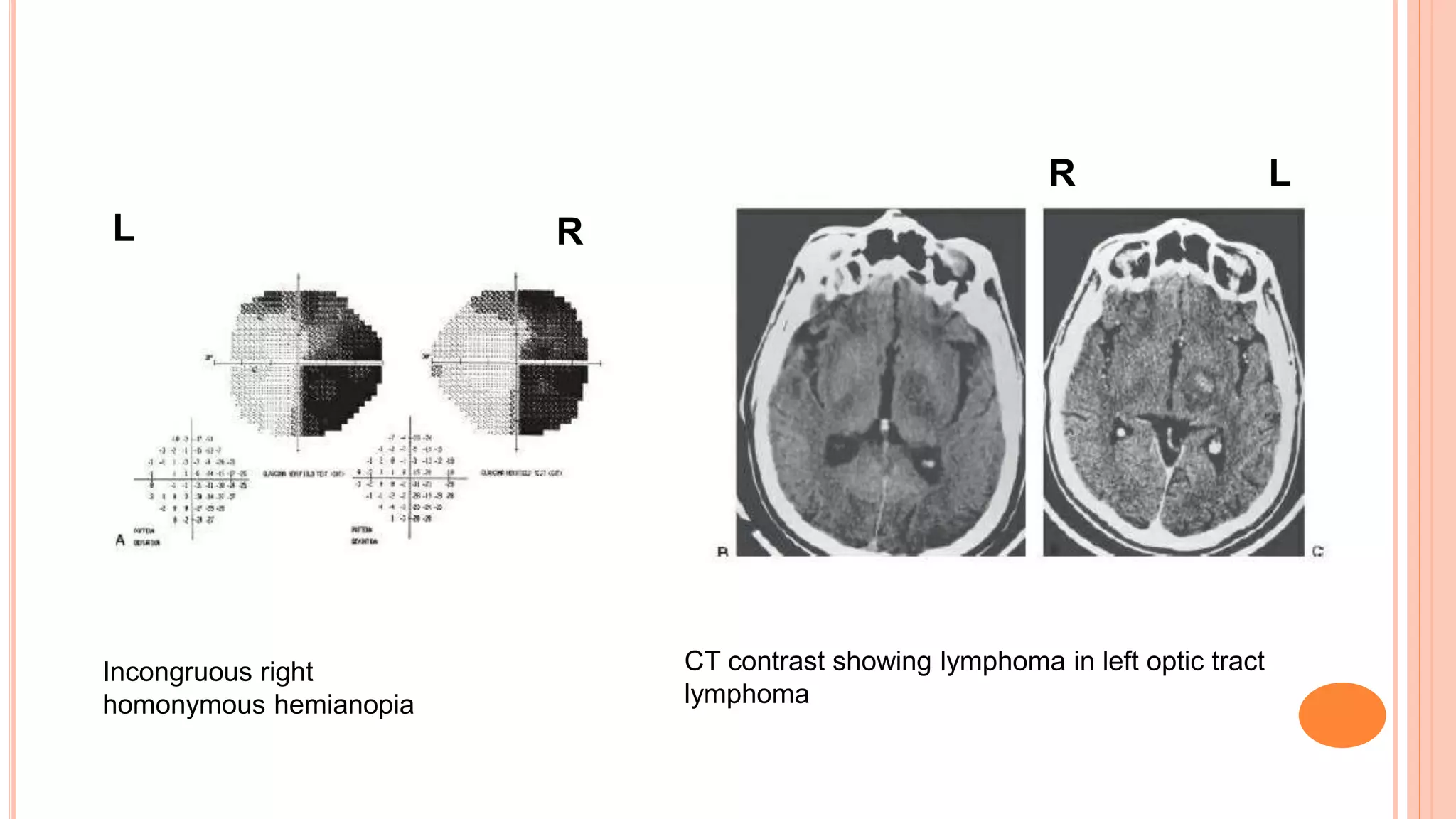 Localizing signs for lesion of visual pathway | PPTX