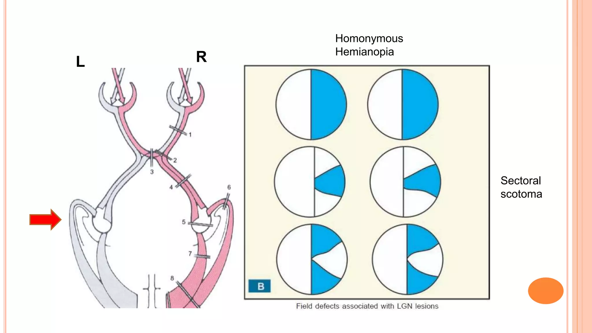 Localizing signs for lesion of visual pathway | PPTX