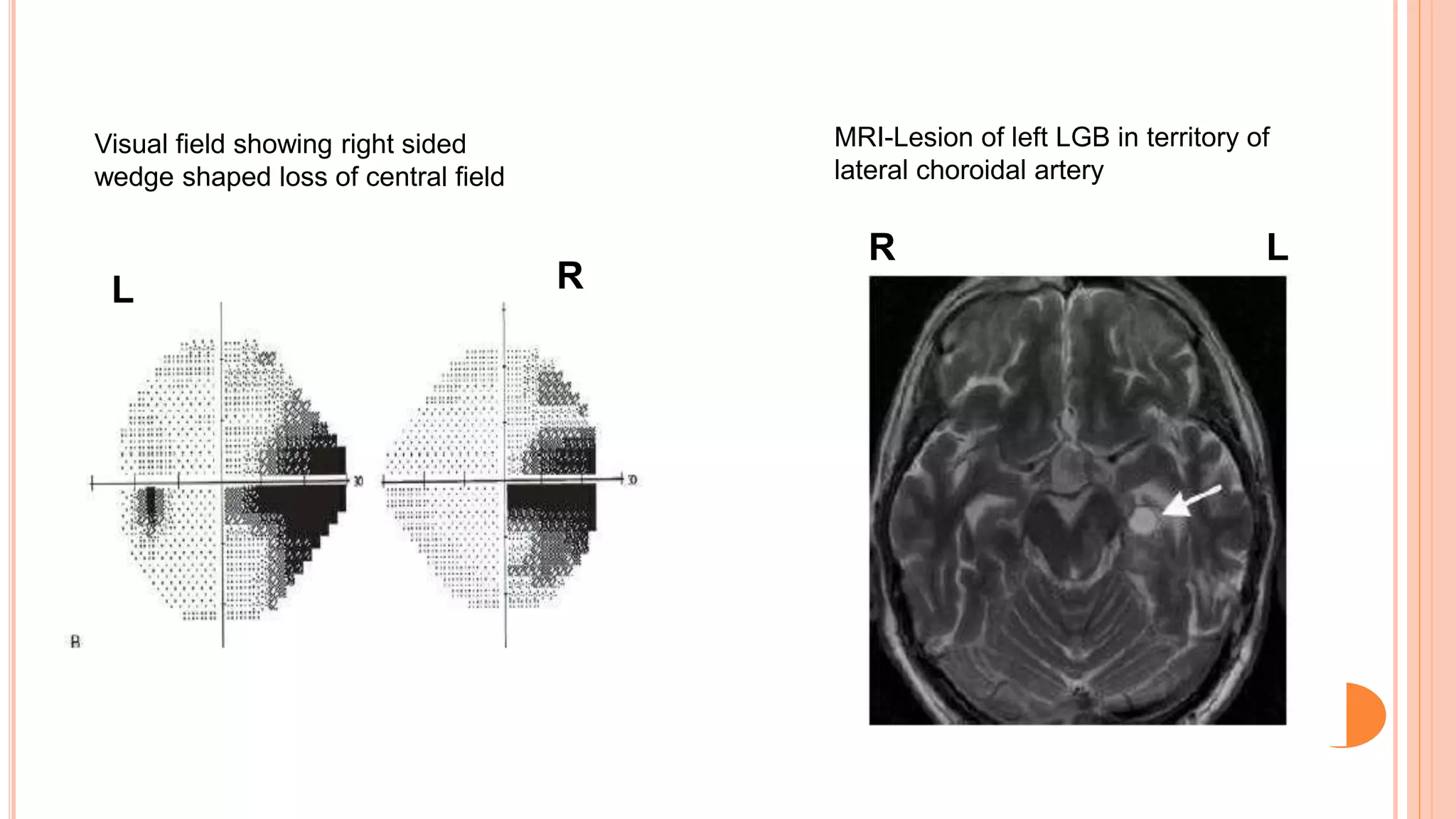 Localizing signs for lesion of visual pathway | PPTX