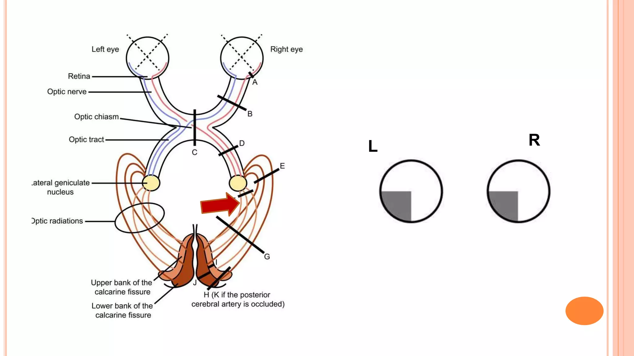 Localizing signs for lesion of visual pathway | PPTX