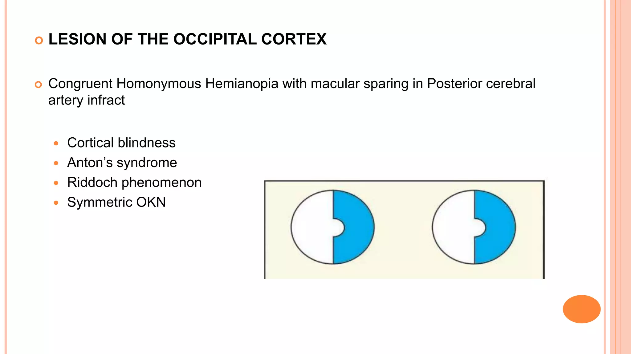 Localizing signs for lesion of visual pathway | PPTX