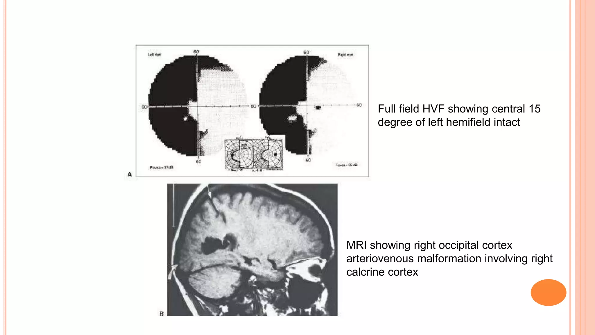 Localizing signs for lesion of visual pathway | PPTX