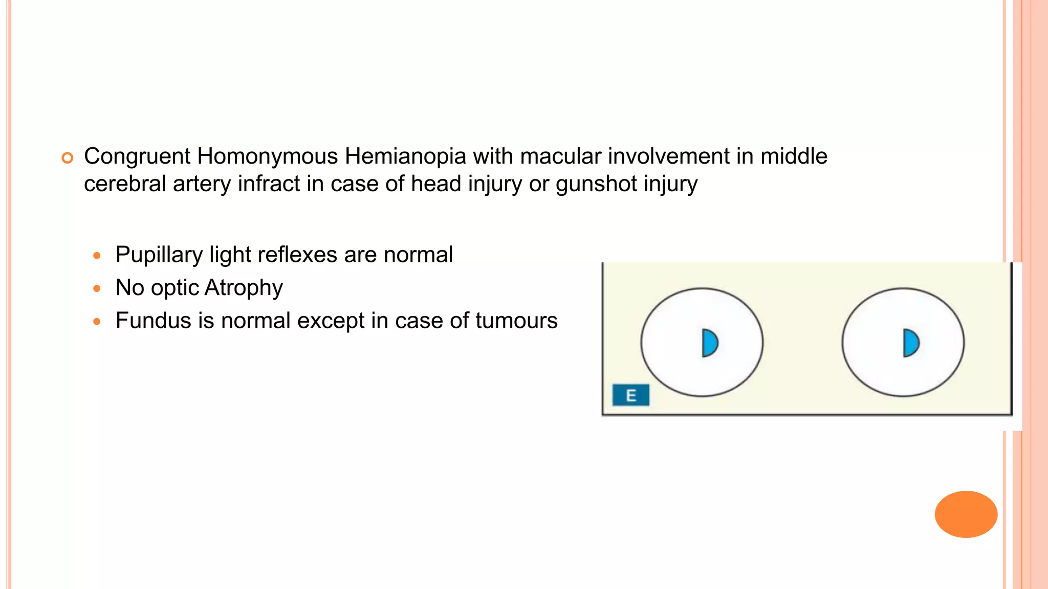 Localizing signs for lesion of visual pathway | PPTX