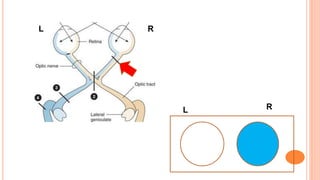 Localizing signs for lesion of visual pathway | PPTX