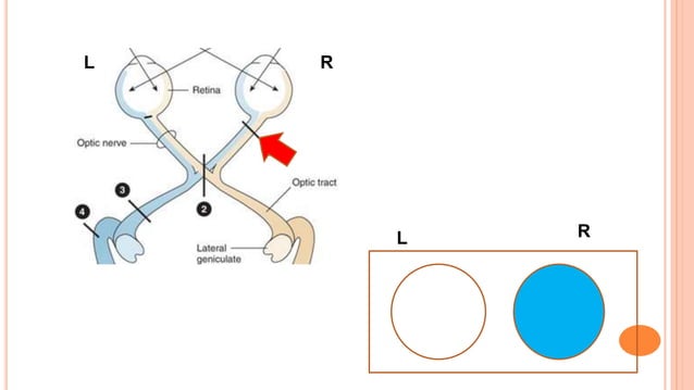 Localizing signs for lesion of visual pathway | PPTX