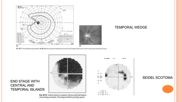 Localizing signs for lesion of visual pathway | PPTX