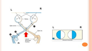 Localizing signs for lesion of visual pathway | PPTX