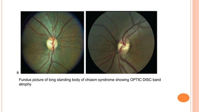 Localizing signs for lesion of visual pathway | PPTX