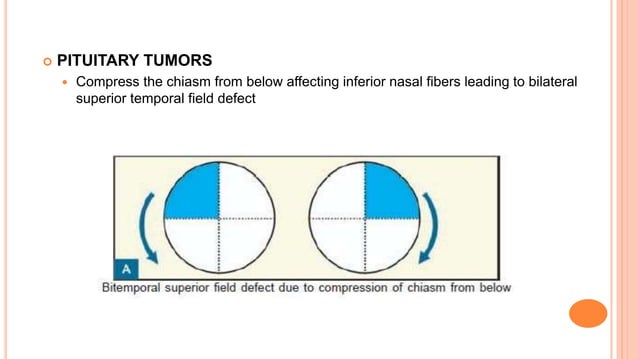 Localizing signs for lesion of visual pathway | PPTX