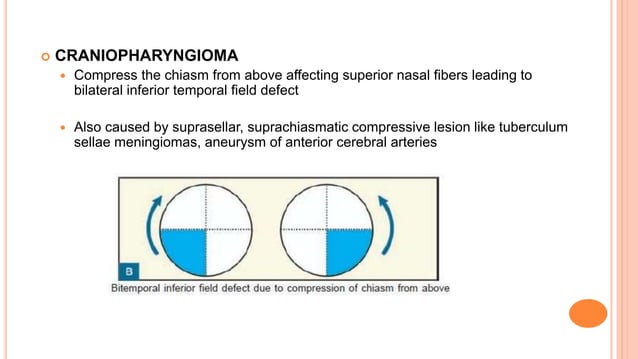 Localizing signs for lesion of visual pathway | PPTX
