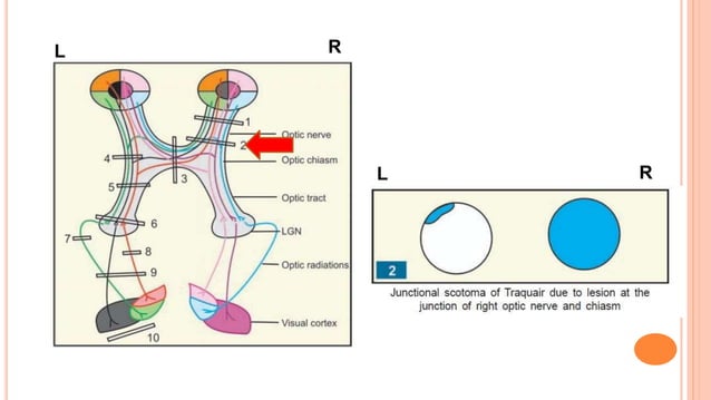 Localizing signs for lesion of visual pathway | PPTX