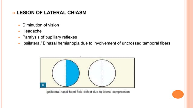 Localizing signs for lesion of visual pathway | PPTX