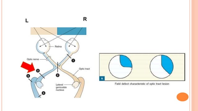 Localizing signs for lesion of visual pathway | PPTX