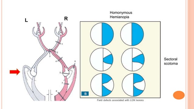 Localizing signs for lesion of visual pathway | PPTX