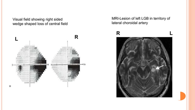 Localizing signs for lesion of visual pathway | PPTX
