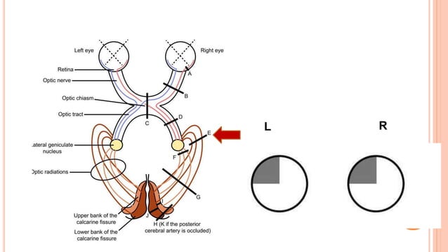 Localizing signs for lesion of visual pathway | PPTX