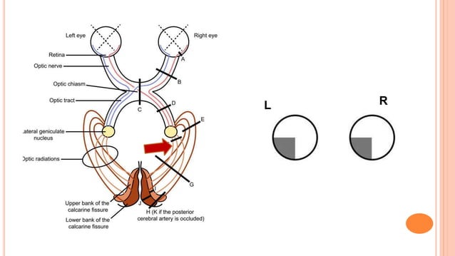 Localizing signs for lesion of visual pathway | PPTX