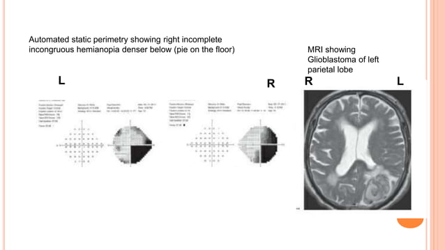 Localizing signs for lesion of visual pathway | PPTX