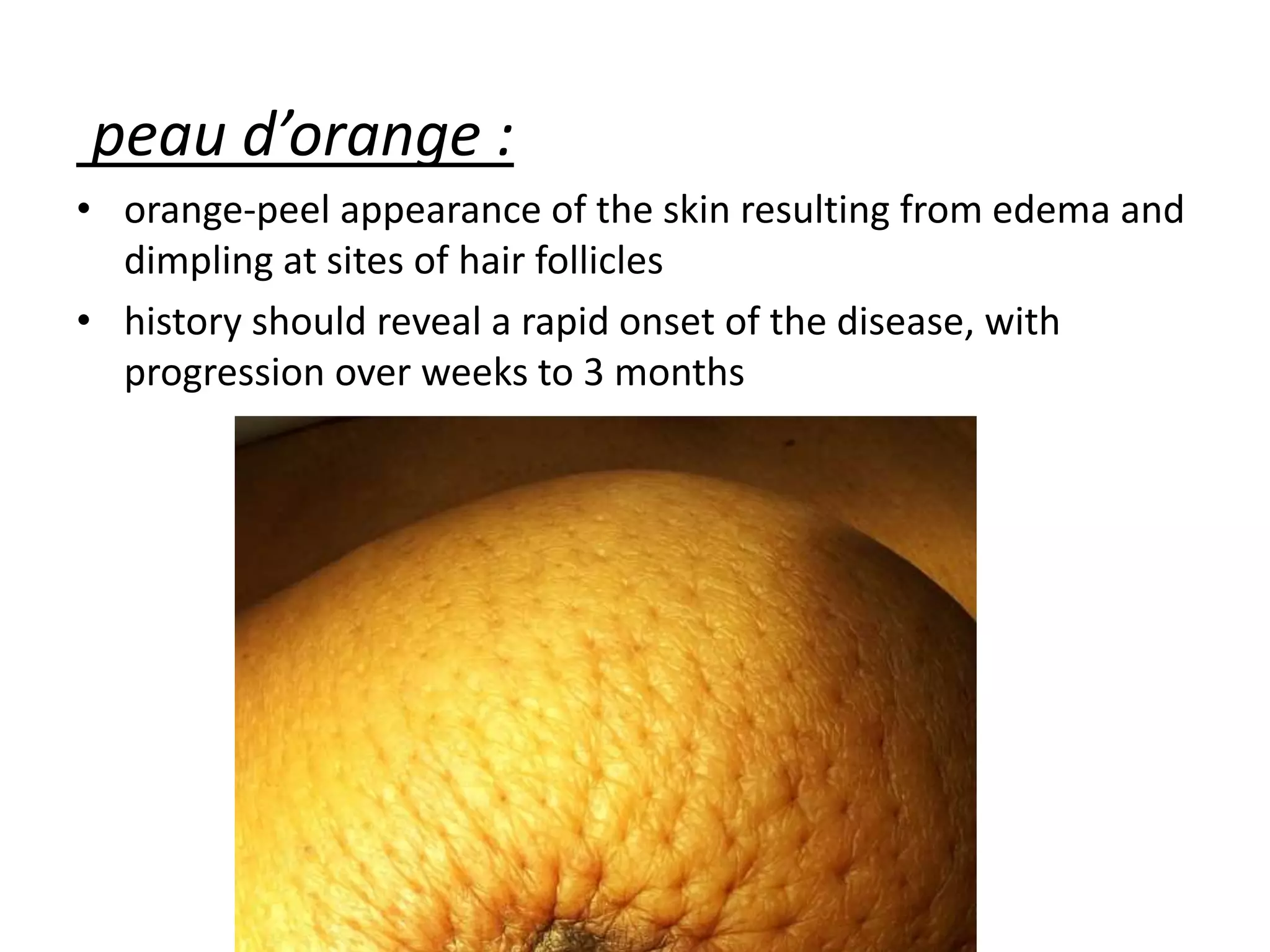 Locally advanced breast cancer | PPTX