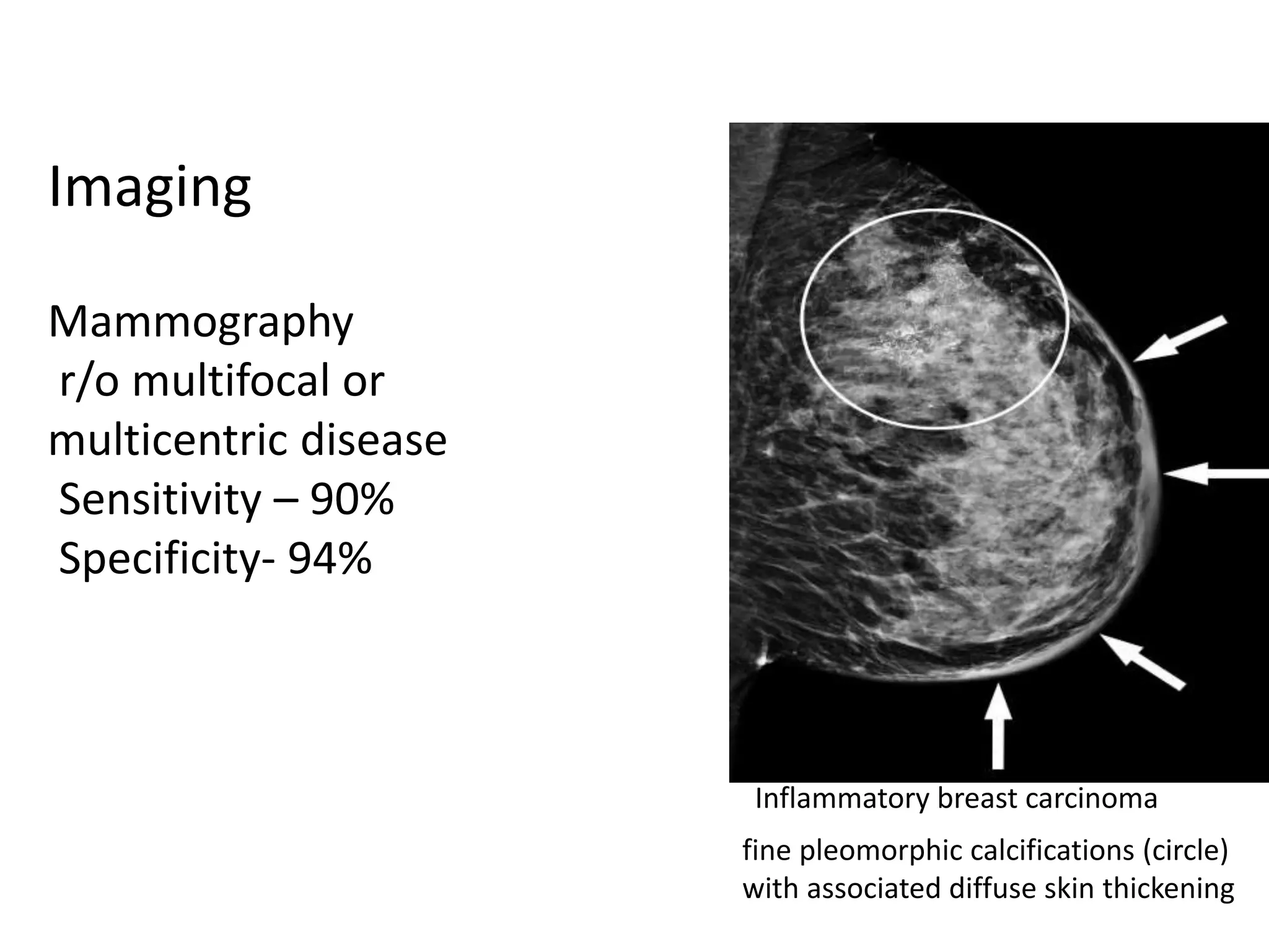 Locally advanced breast cancer | PPTX