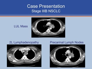 Locally Advanced Nsclc | PPT