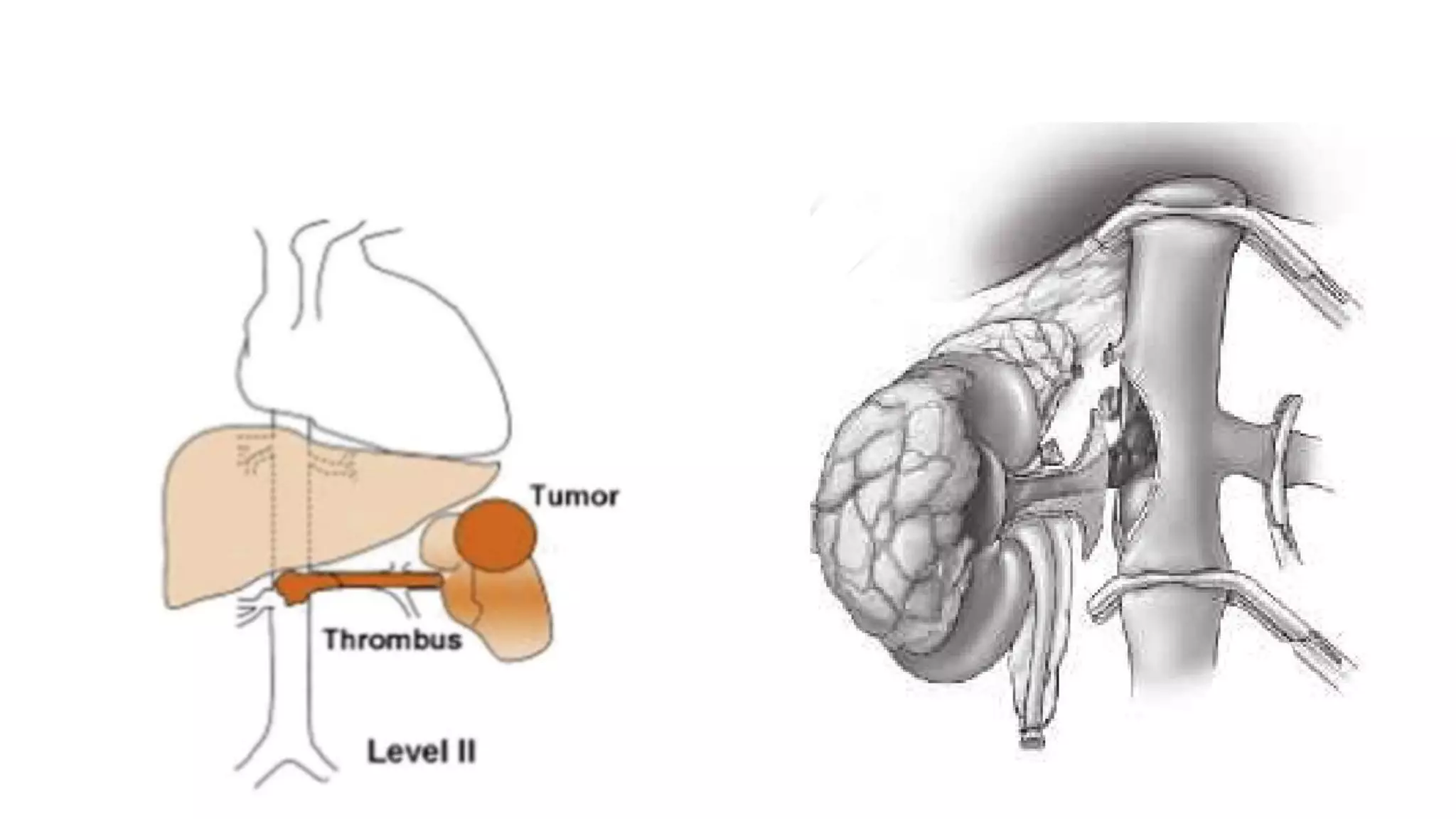Locally advanced renal cell carcinoma RCC | PPTX