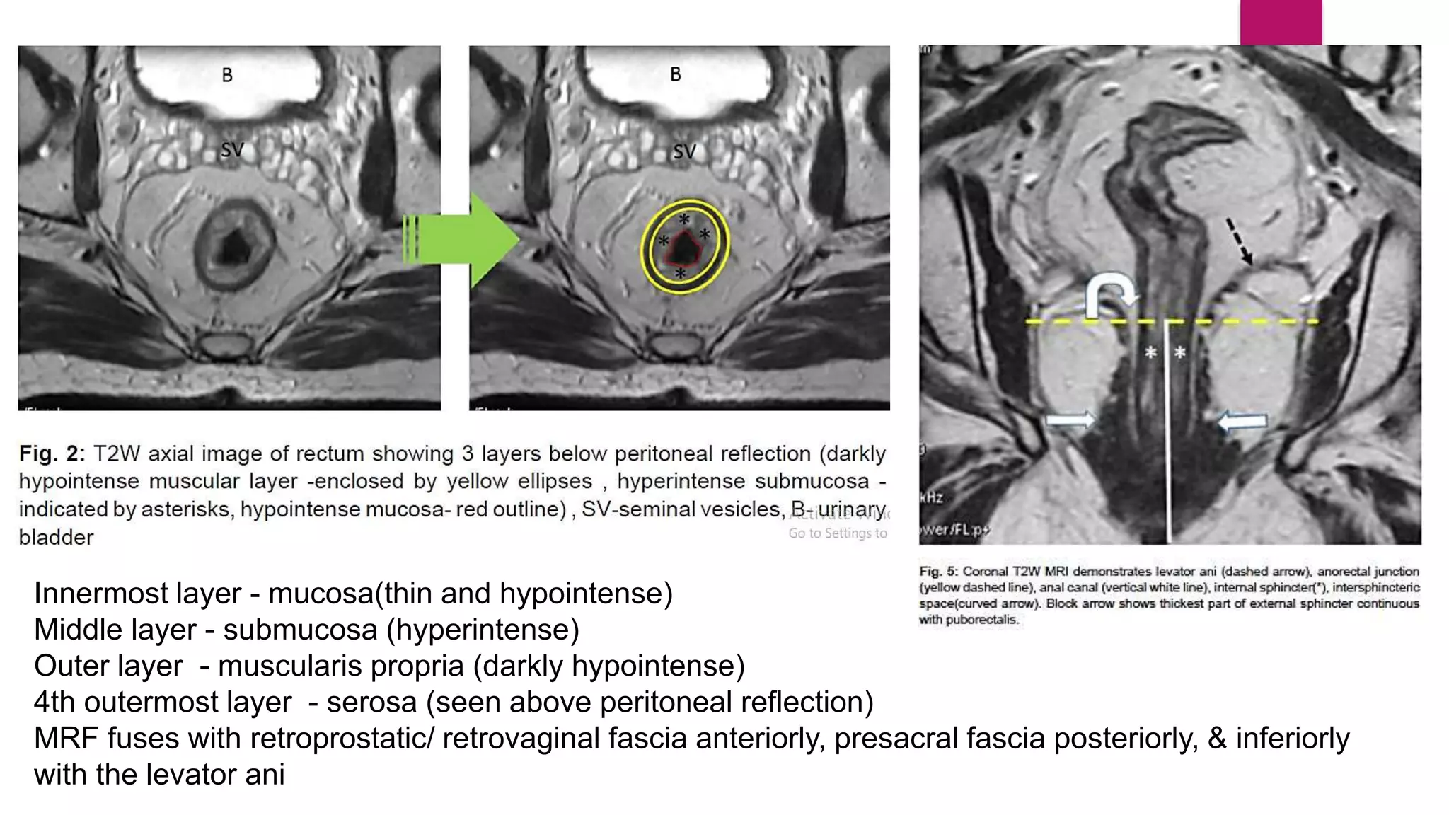 Locally Advanced Rectal Cancer | PPTX