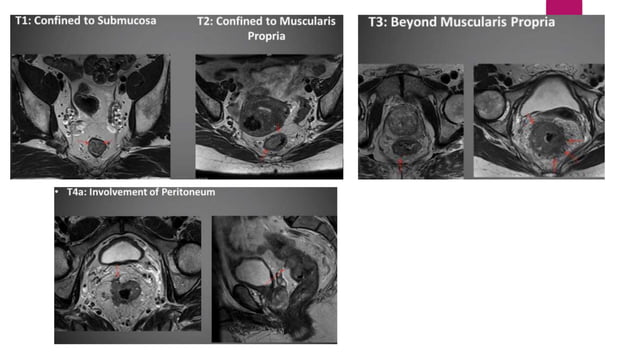 Locally Advanced Rectal Cancer | PPTX