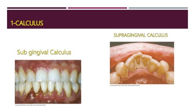 Local predisposing factor of periodontal disease