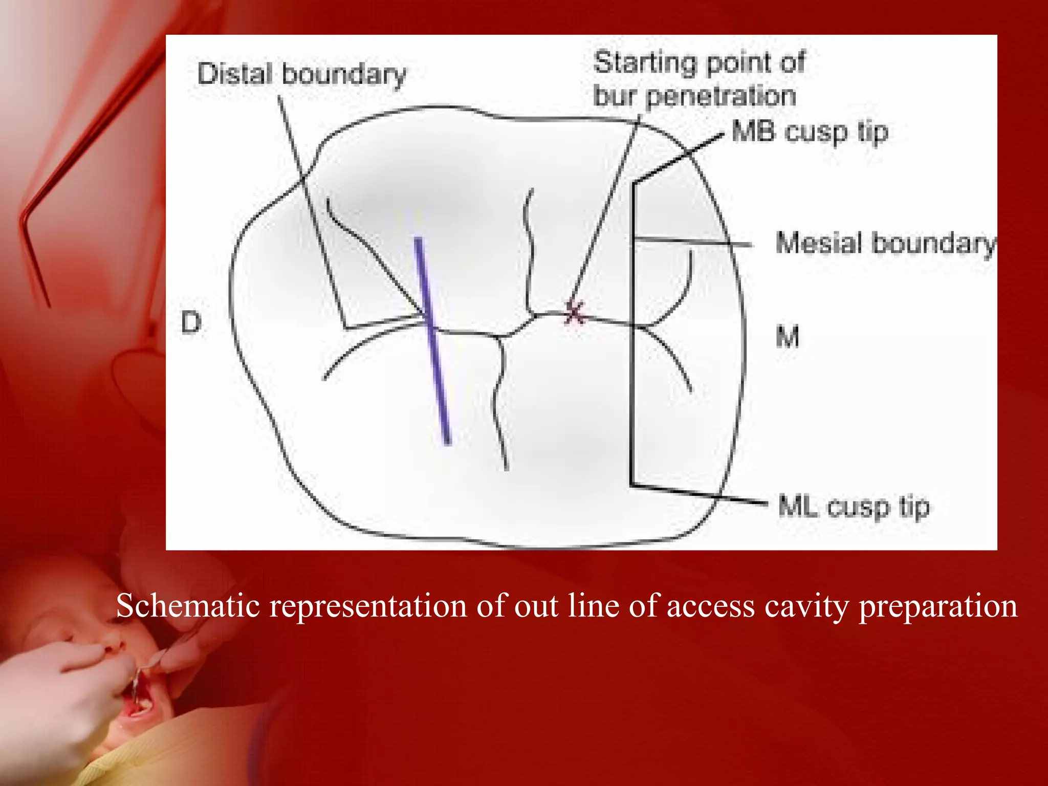 Locating root canal orifice in molar RCT | PPT