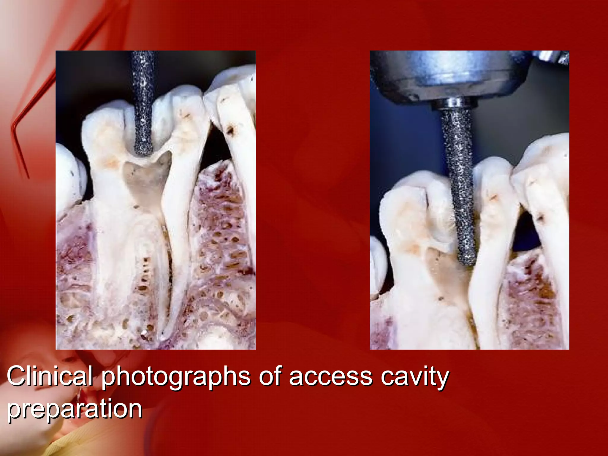 Locating root canal orifice in molar RCT | PPT