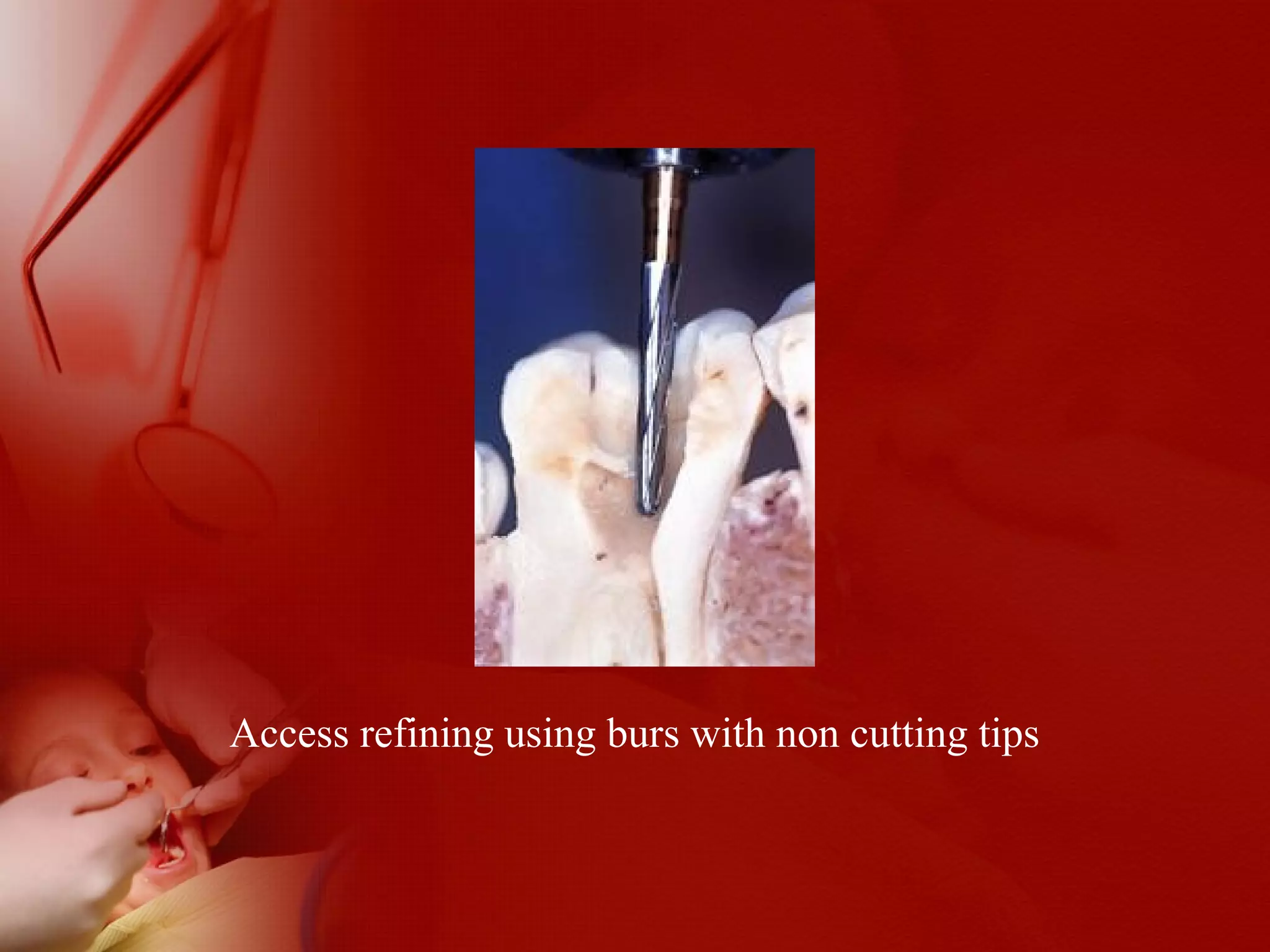 Locating root canal orifice in molar RCT | PPT
