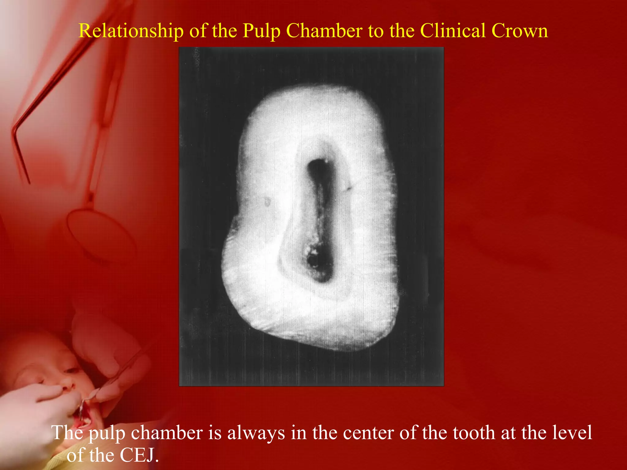 Locating Root Canal Orifice In Molar Rct Ppt