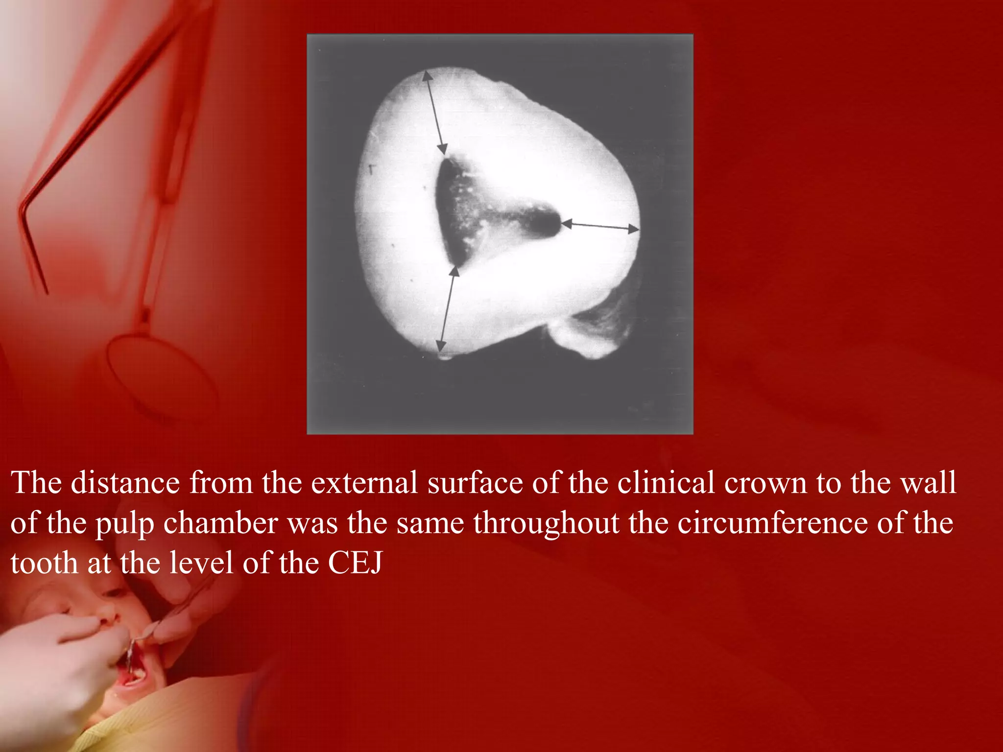Locating Root Canal Orifice In Molar Rct Ppt