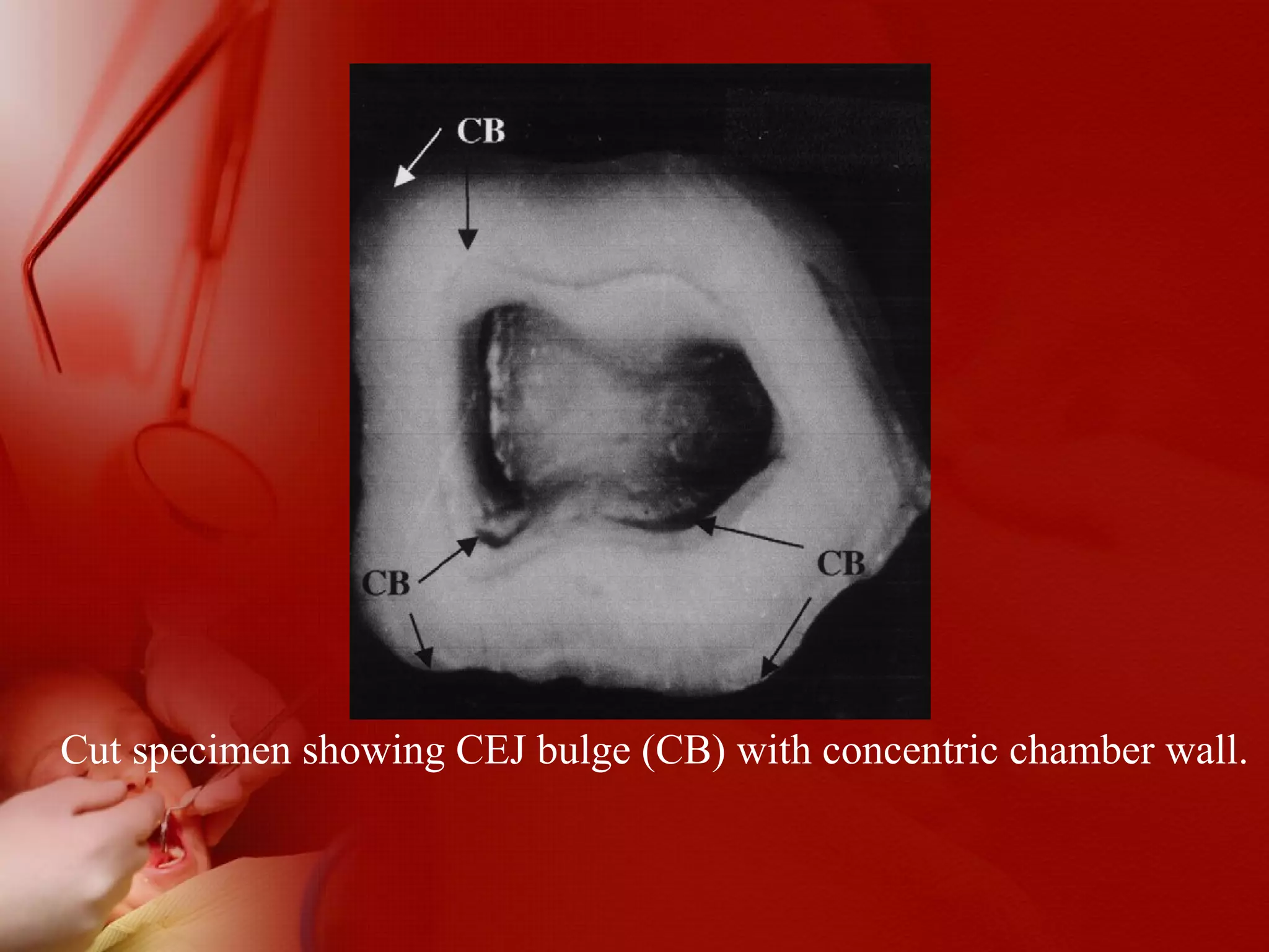 Locating root canal orifice in molar RCT | PPT